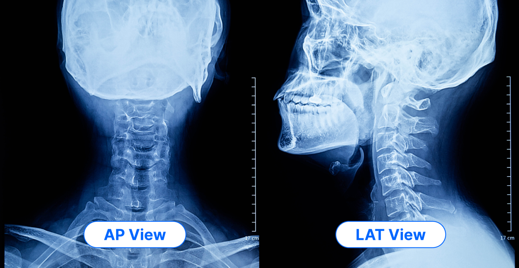 How to Read an X-Ray Report: Lucency, Acute Osseous Abnormality & More