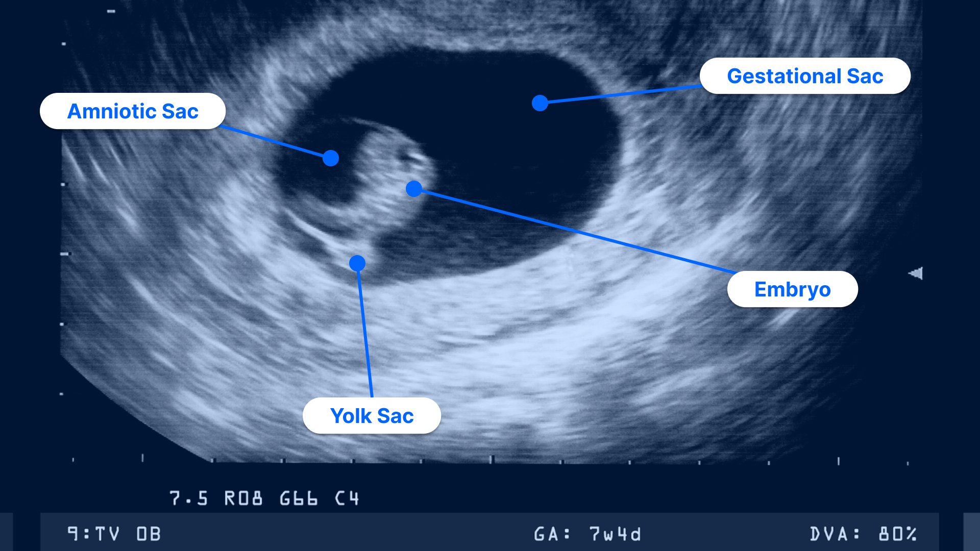 7-Week Ultrasound: Pictures, Heartbeat, Twin Pregnancy and More 7-Week Ultrasound: Pictures, Heartbeat, Twin Pregnancy and More
