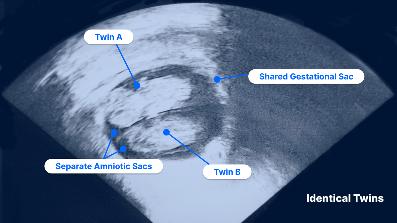 Twin Pregnancy Ultrasound | PocketHealth