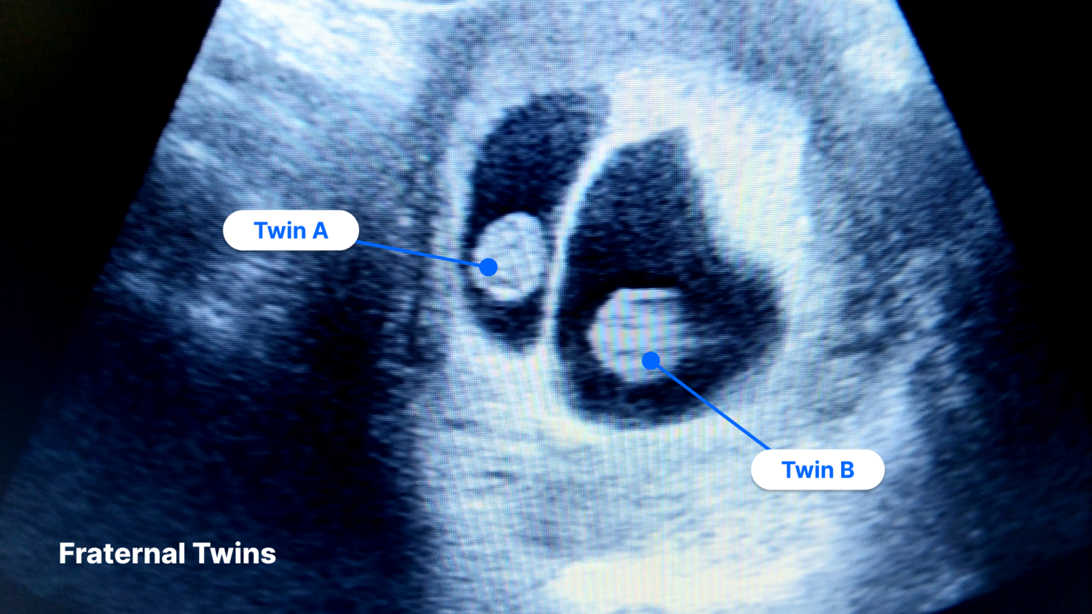 Twin Pregnancy Ultrasound: Identical, Fraternal & Hidden