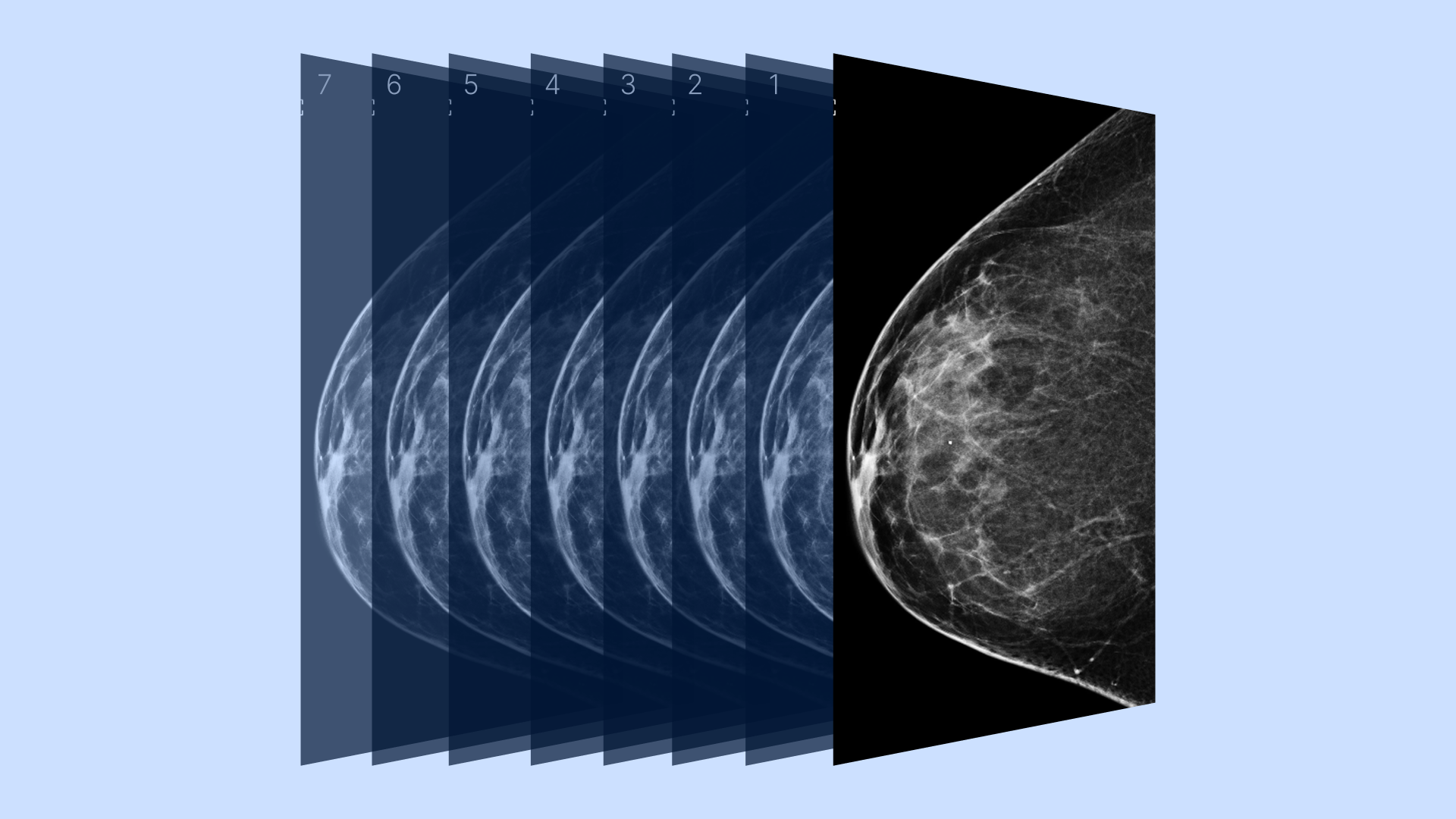 3D Mammogram: Who Needs One, What to Expect and More