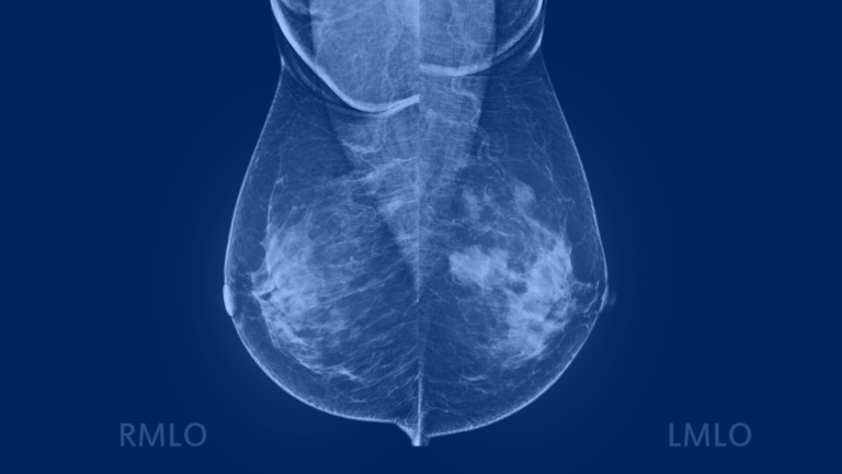 Diagnostic Mammogram and Breast Cancer | PocketHealth