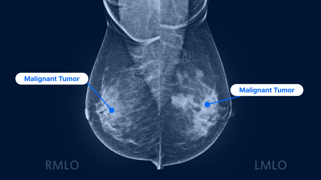 Diagnostic Mammogram and Breast Cancer | PocketHealth