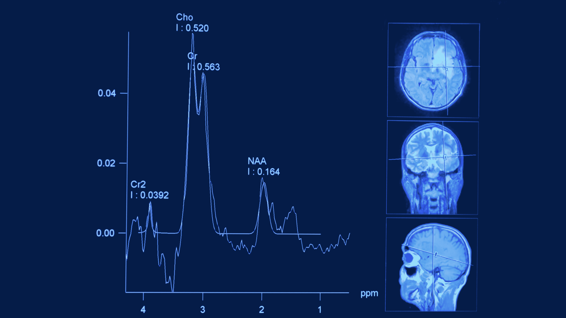 A Patient’s Guide to Magnetic Resonance Spectroscopy | PocketHealth
