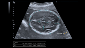 Fetal Biometry: What is BPD on an Ultrasound?