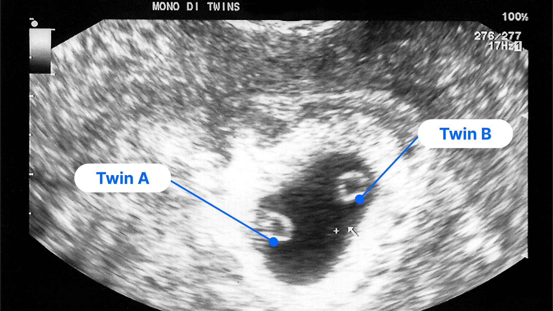 6-Week Pregnancy Ultrasound: Yolk Sac, Fetal Pole, Heartbeat & More