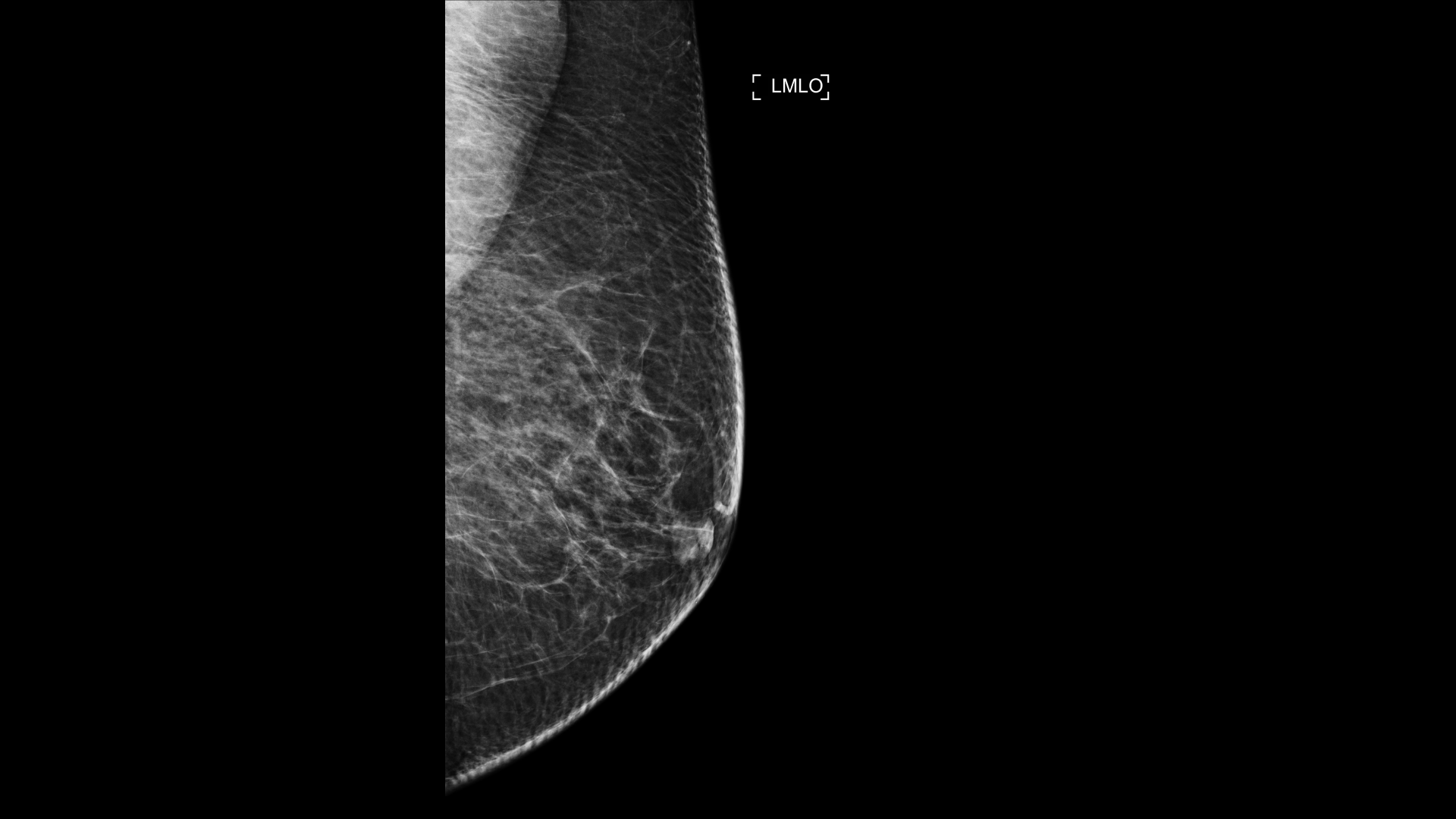 How to Read Mammogram Results: BI-RADS, Asymmetries & More