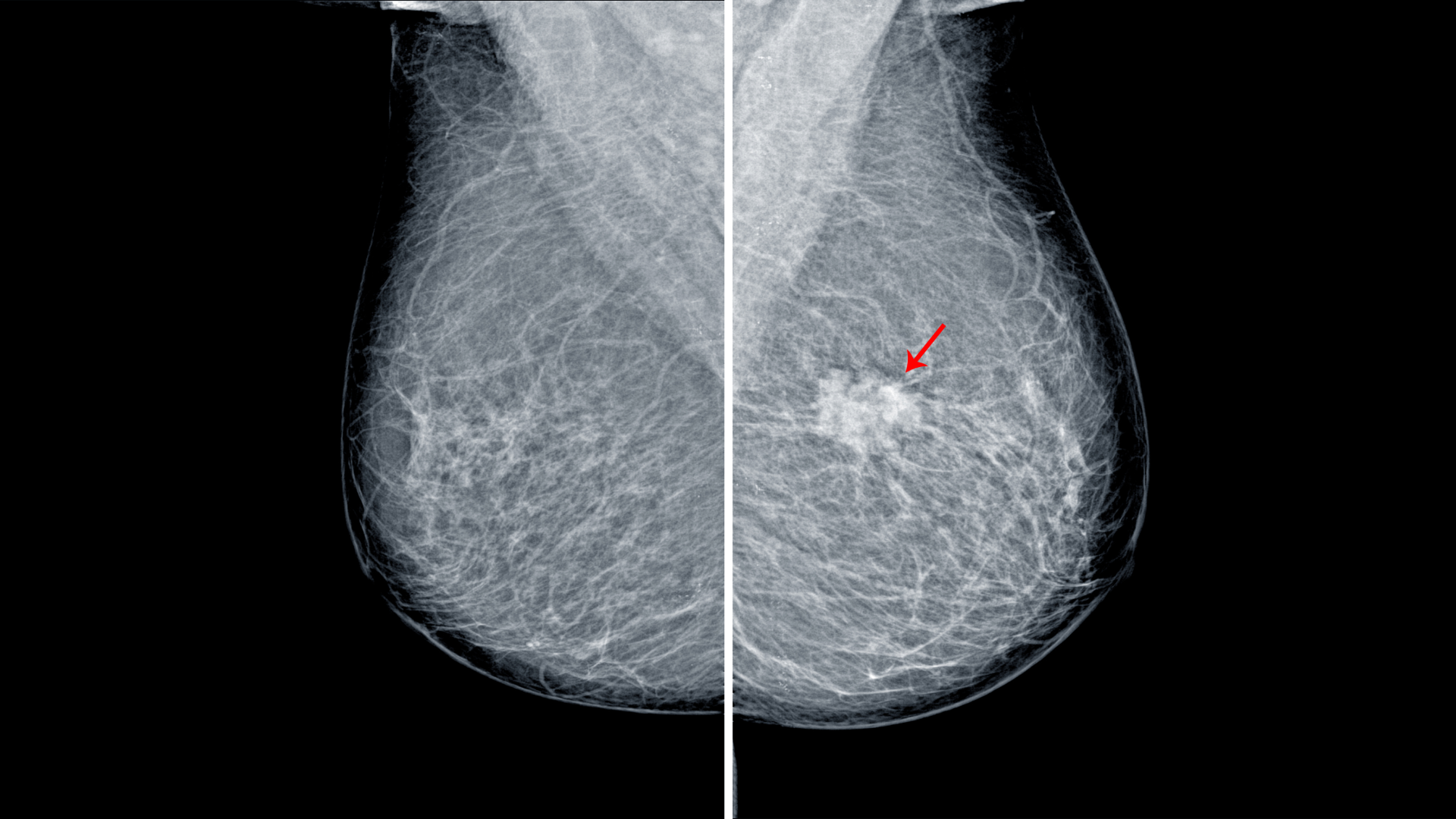 How to Read Mammogram Results: BI-RADS, Asymmetries & More