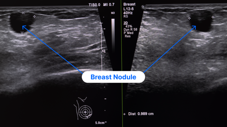 Breast Cysts: Symptoms, Types, Diagnosis and Treatment