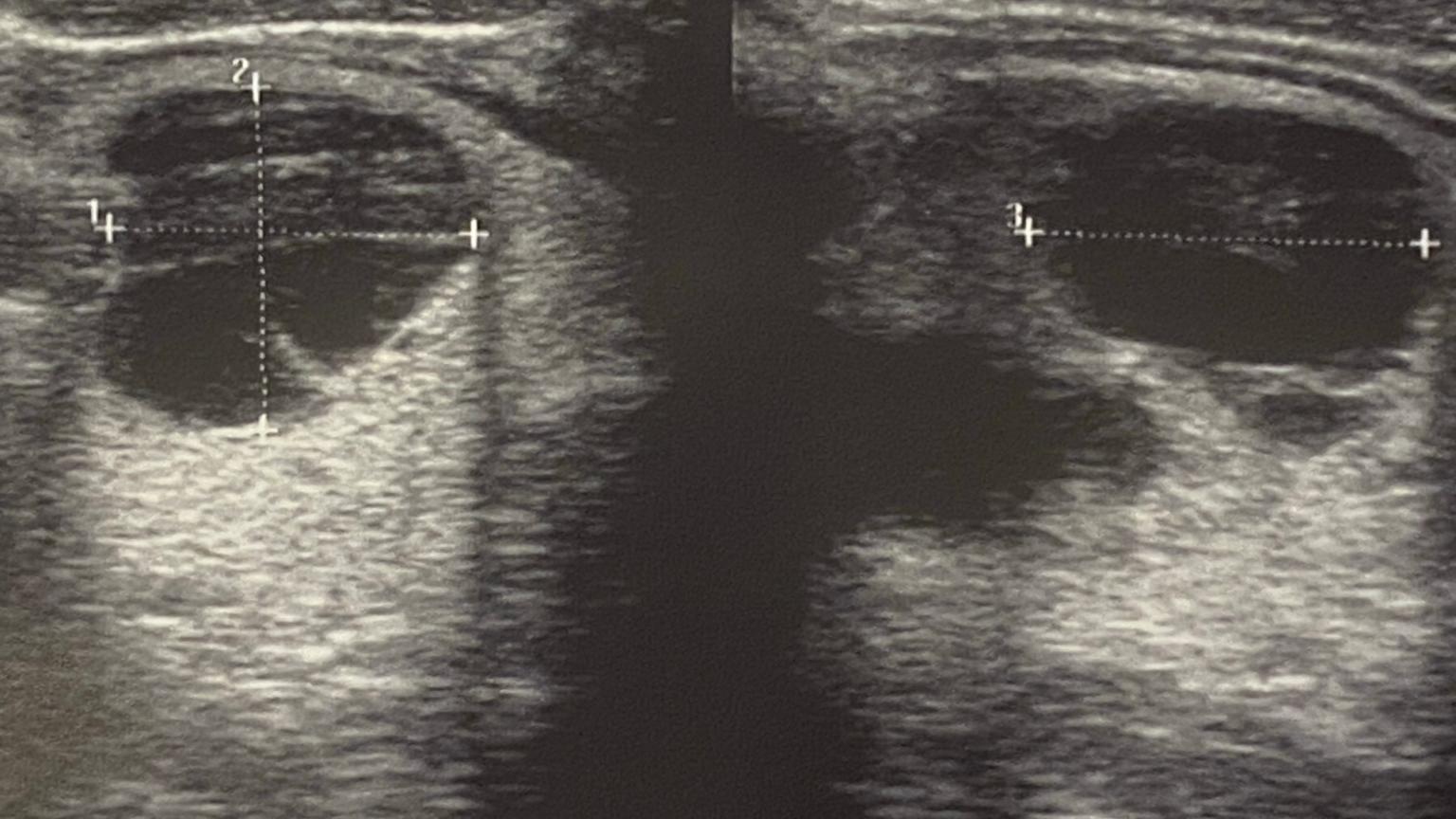 Hypoechoic Mass On Ultrasound Nodules Lesions And Cysts
