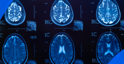 Brain MRI: How to Prepare and What to Expect