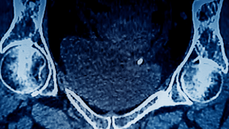 CT Scan for Kidney Stones: How to Prepare and What to Expect