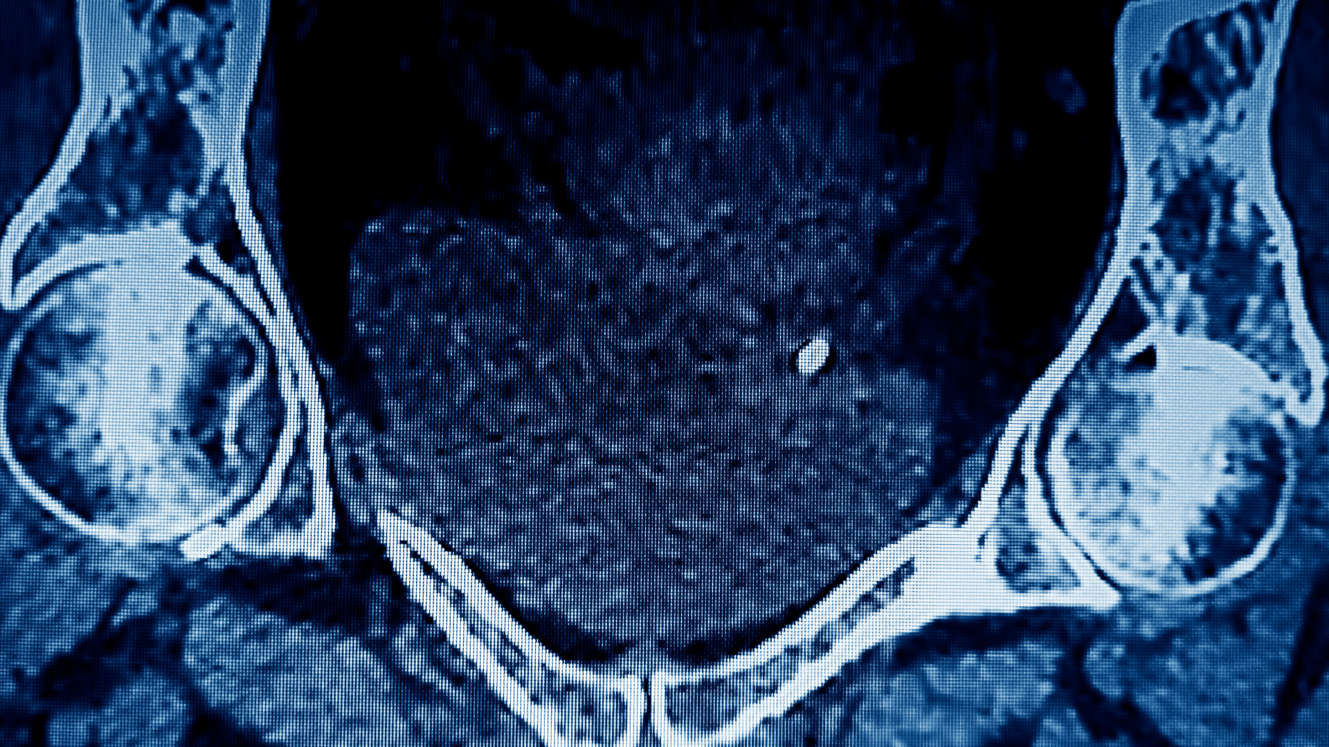 CT Scan for Kidney Stones: How to Prepare and What to Expect