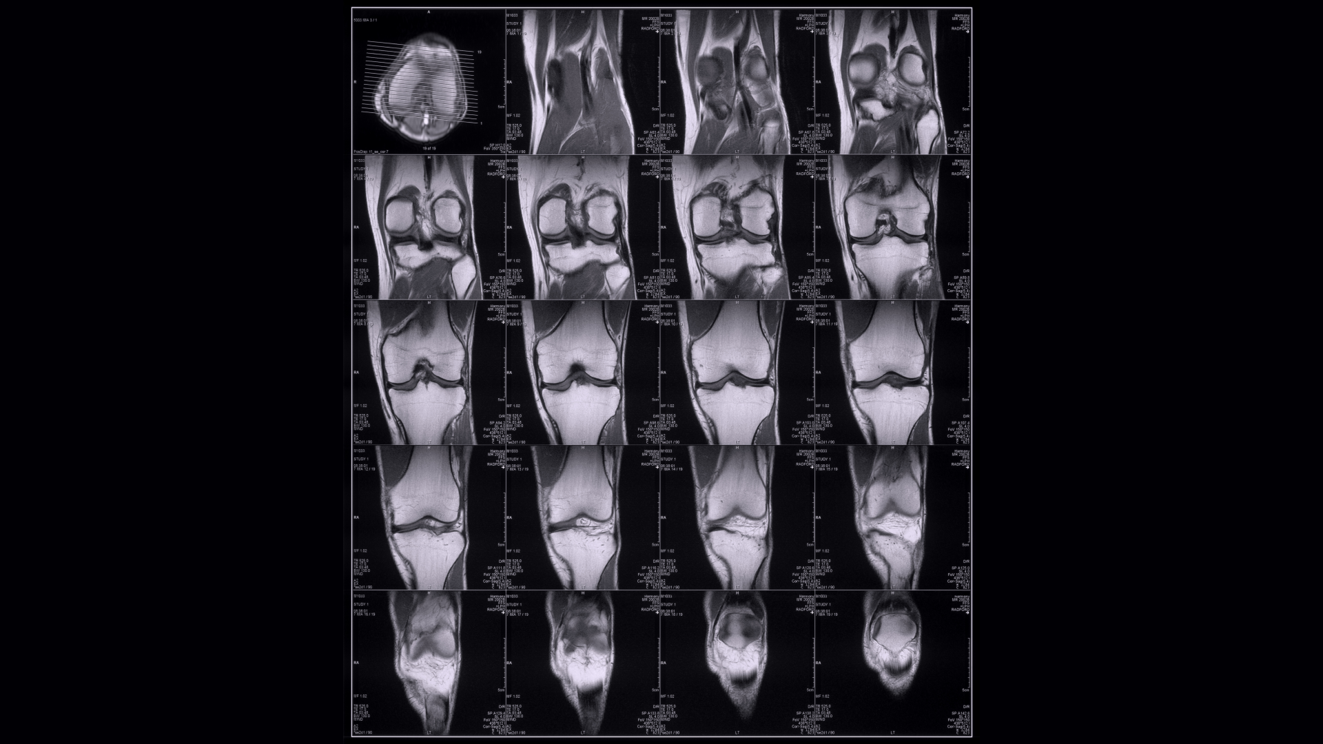 Knee MRI: Preparing for your Appointment and What to Expect