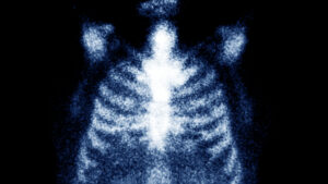 Everything You Should Know About Getting a Bone Scan