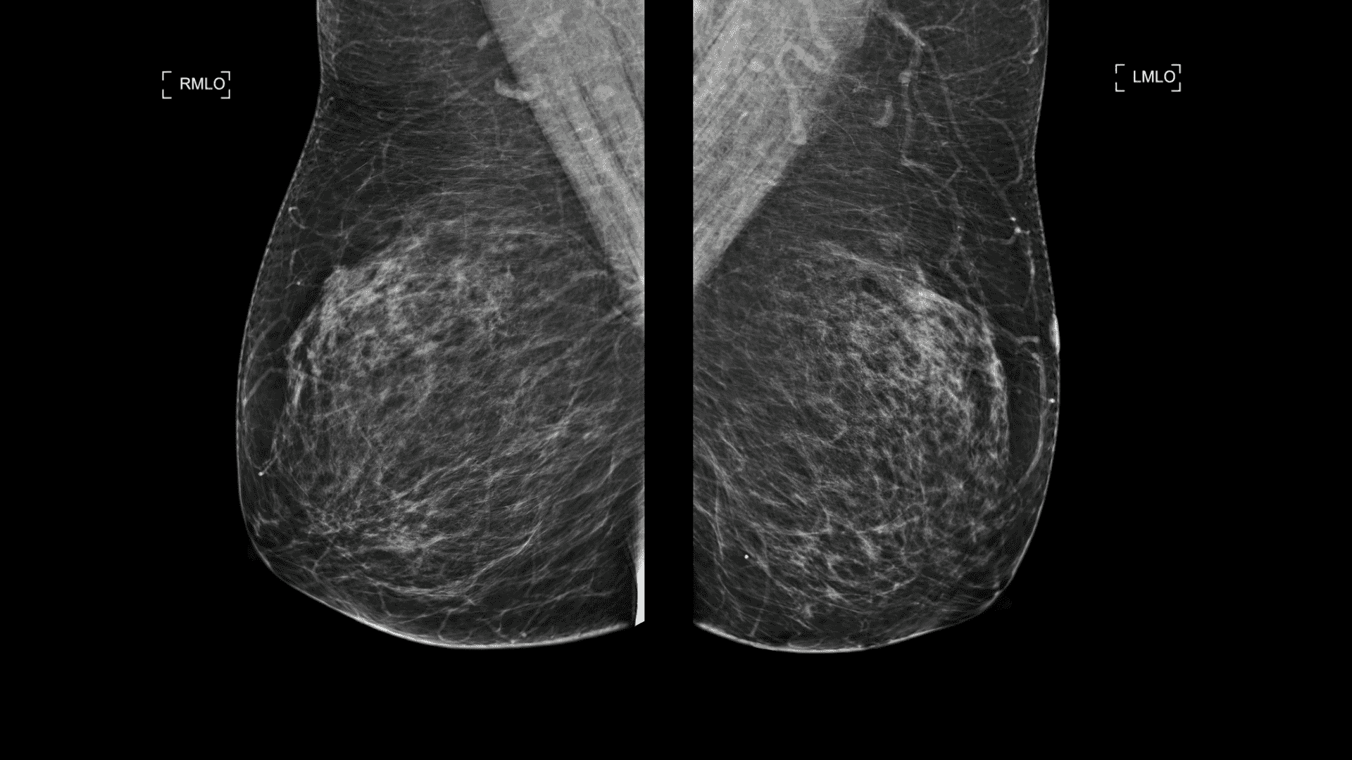 Breast Tomosynthesis: Procedure, Preparation and Results