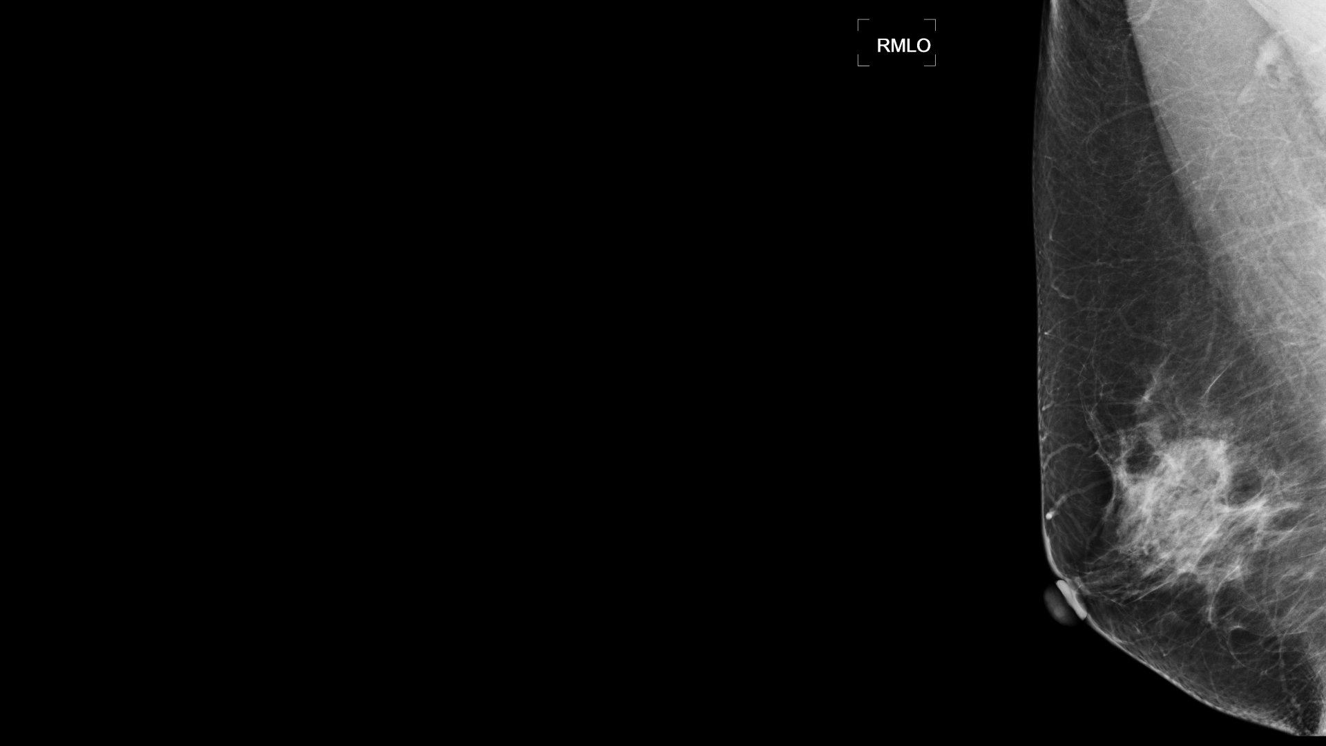 Breast Tomosynthesis: Procedure, Preparation and Results