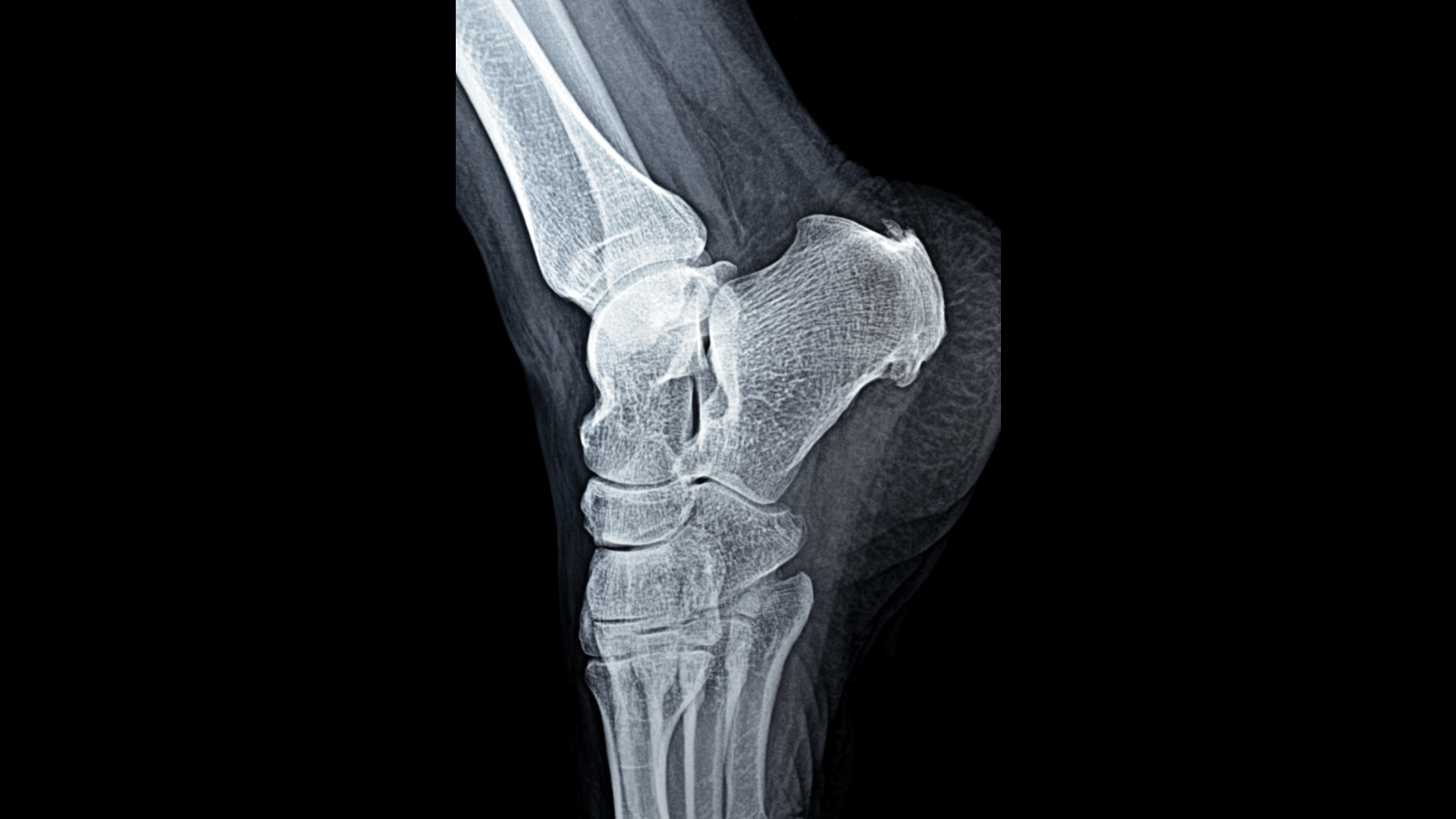 Osseous: Lesions, Bone Abnormalities and More