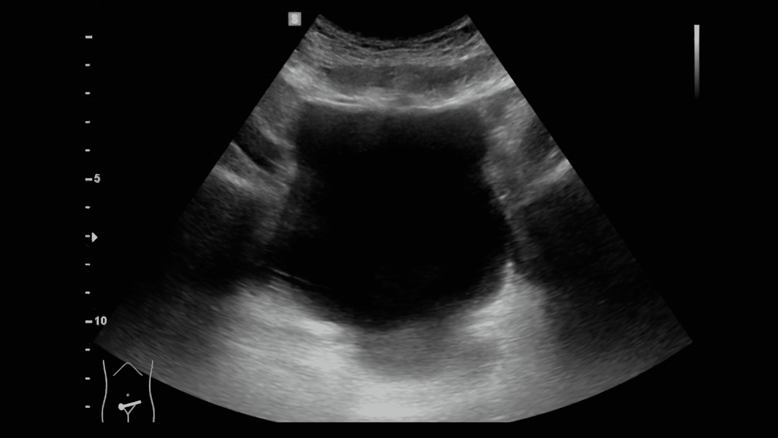 Bladder Ultrasound: Procedure, Preparation and Results