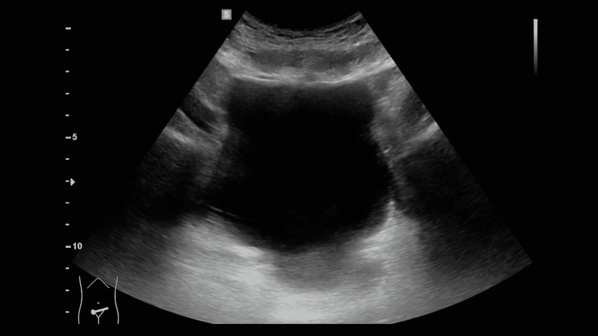 Bladder Ultrasound: Procedure, Preparation and Results