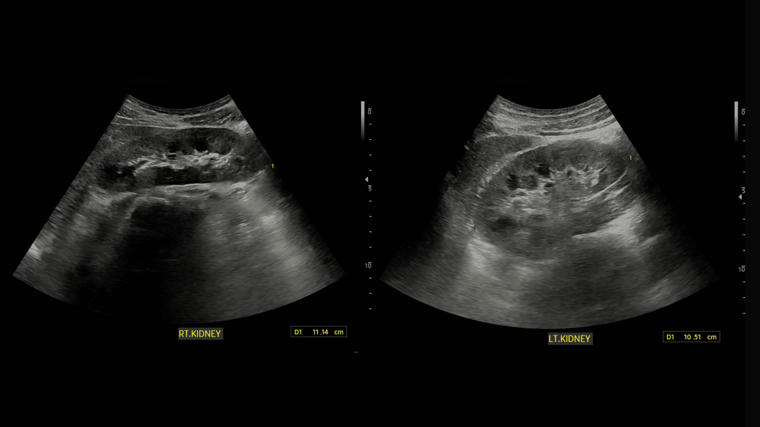 Bladder Ultrasound: Procedure, Preparation and Results