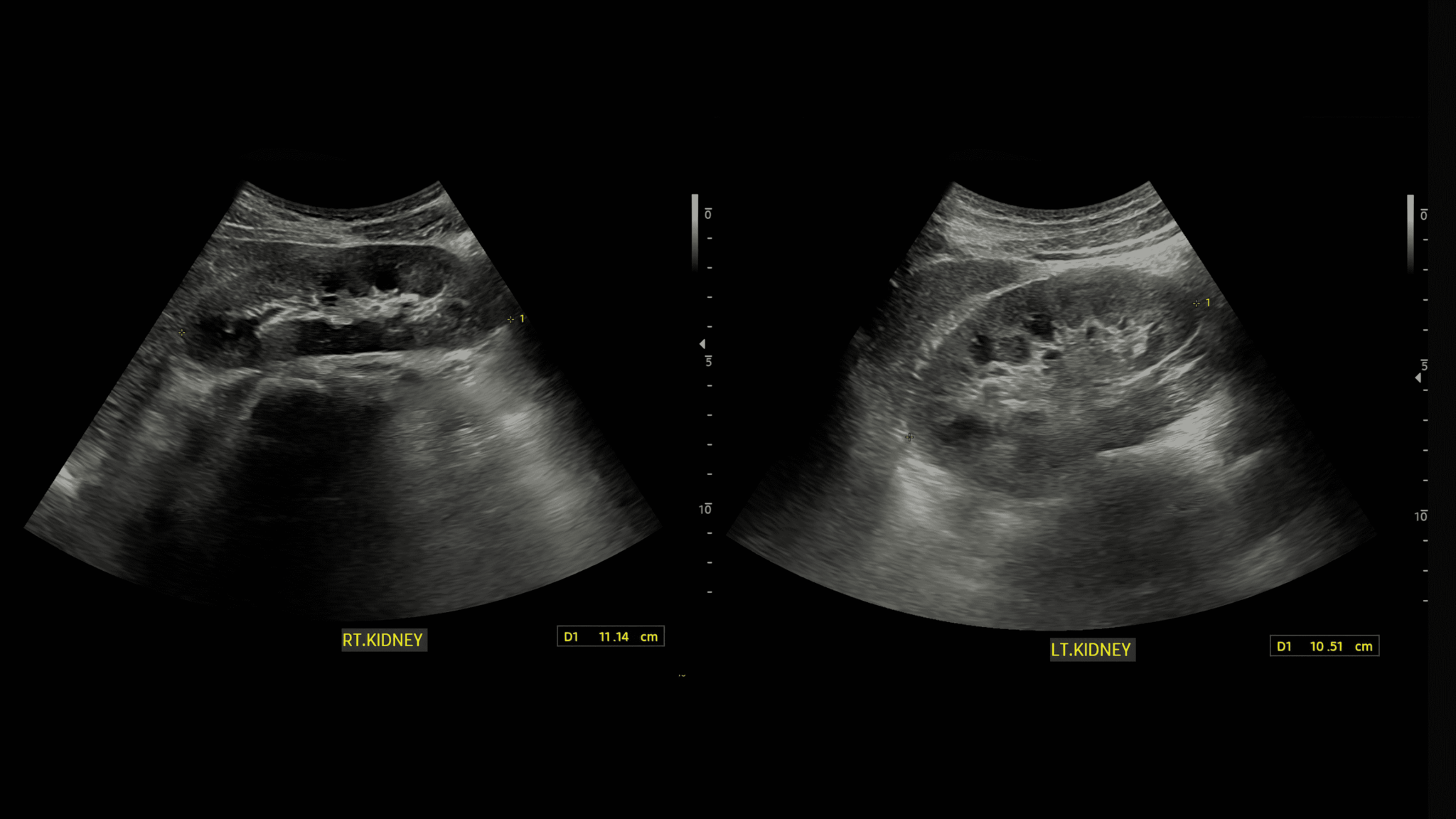 Bladder Ultrasound: Procedure, Preparation and Results