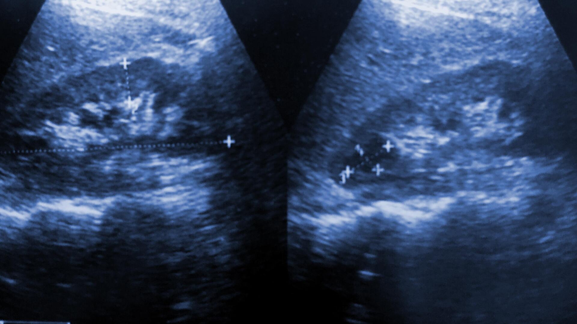 Polycystic kidney disease ultrasound: How to prepare and what to expect
