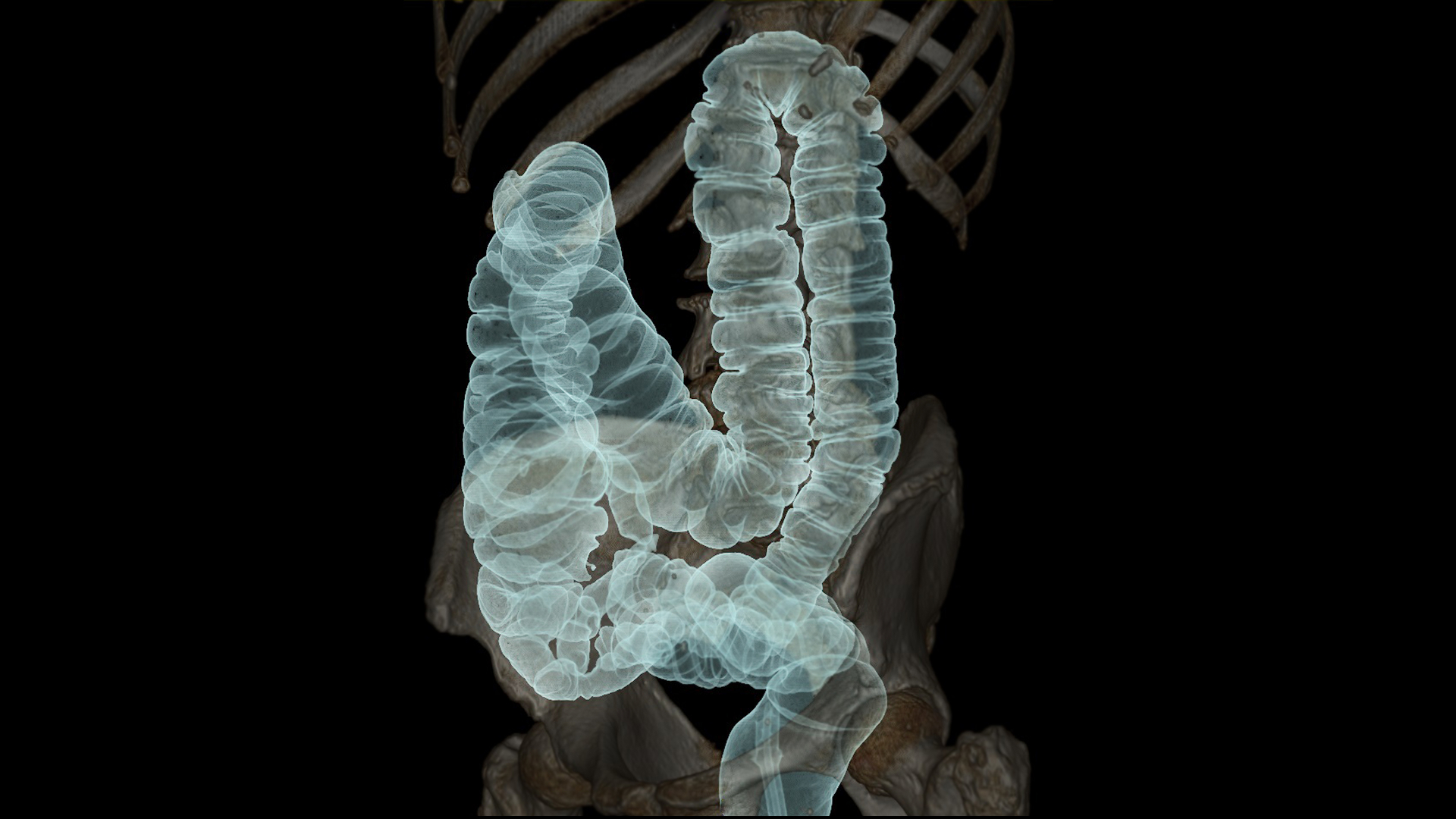 Can CT Scans Detect Colon Cancer?